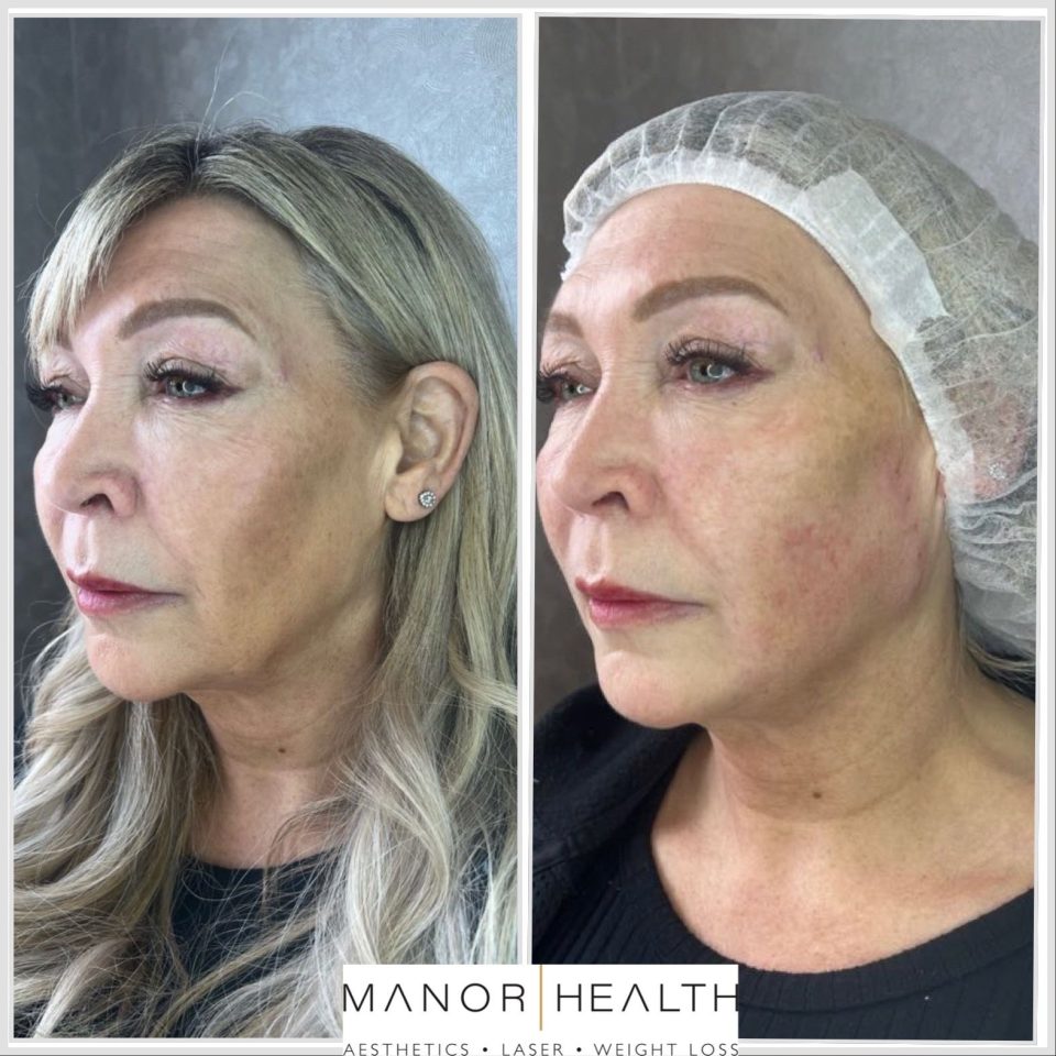 Cogs - PDO Facial Thread Lift: A Game Changer For Anti-Ageing - Manor ...