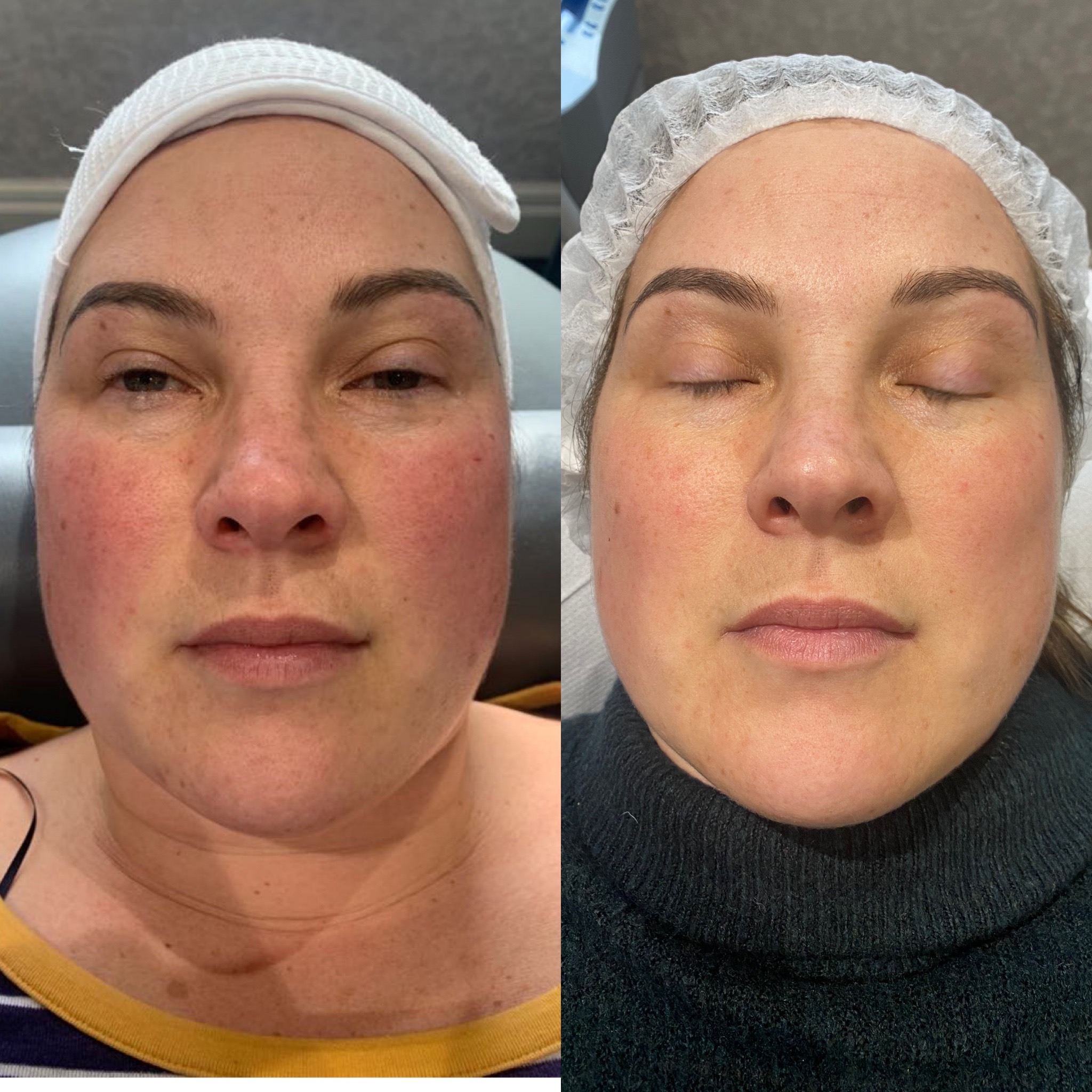 illimiFacial Skin Rejuvenation Leeds | IPL Laser Treatment